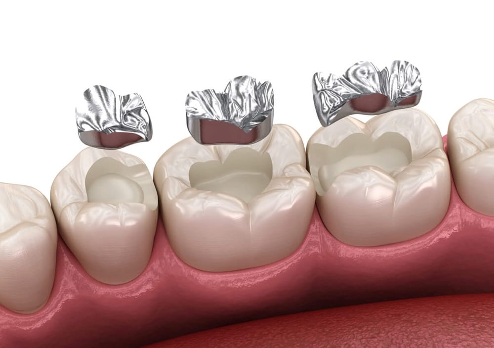 How to Make Composite Fillings Last Longer: Tips from Dentists